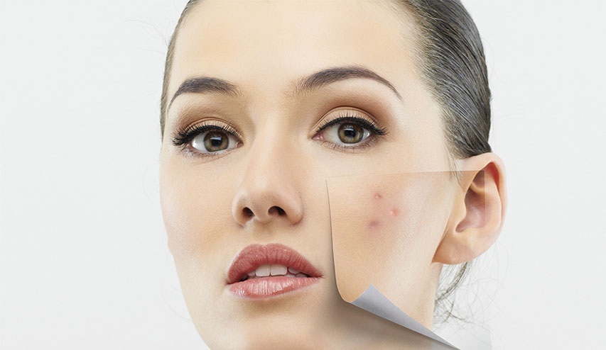 Acné évolutive & cicatrices | Visage & Cou | Dr. Salma Ben Romdhane